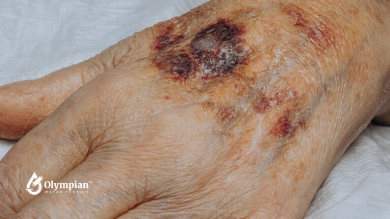 What bacteria commonly cause skin rashes from water exposure - Olympian ...