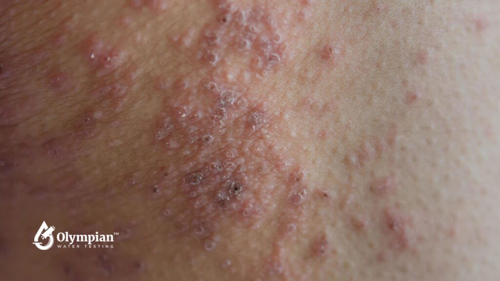 When should I see a doctor for a skin rash from waterborne bacteria ...